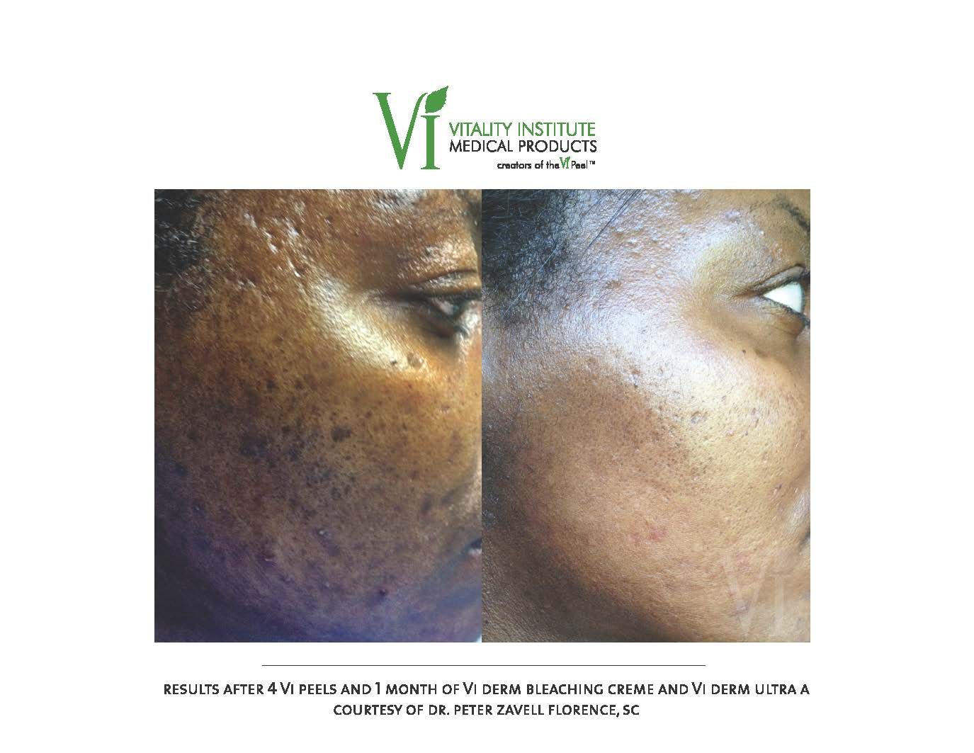 Professional Anti Wrinkle Treatment In Birmingham, West Midlands.