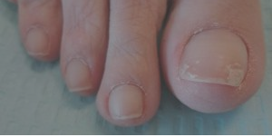 About Fungal Nail Infections