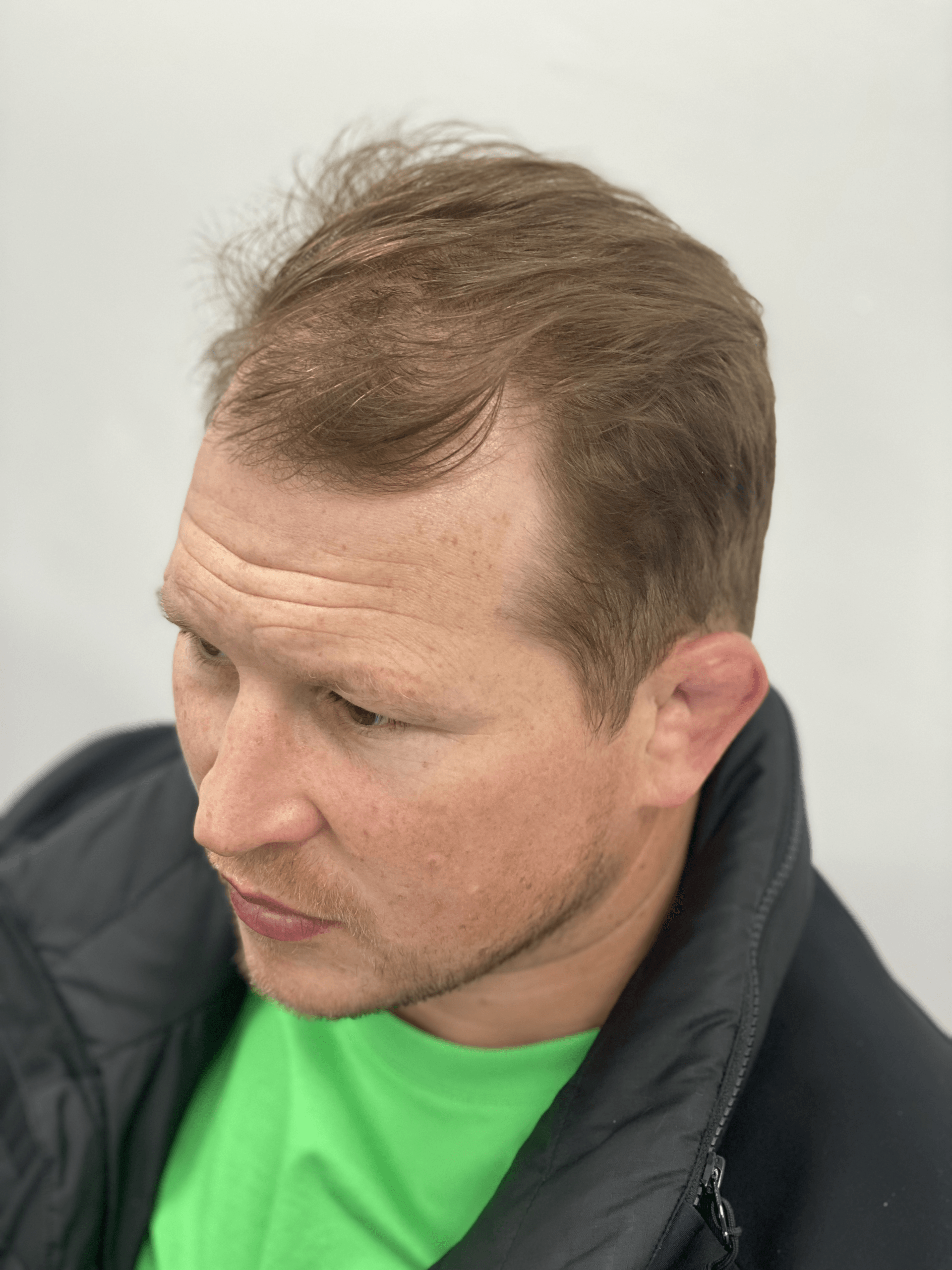 Hair Transplant Treatment | Hair Regrowth | FUE Hair Treatment