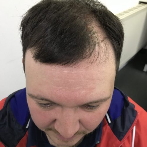 British Hair Clinic | Hair Transplant