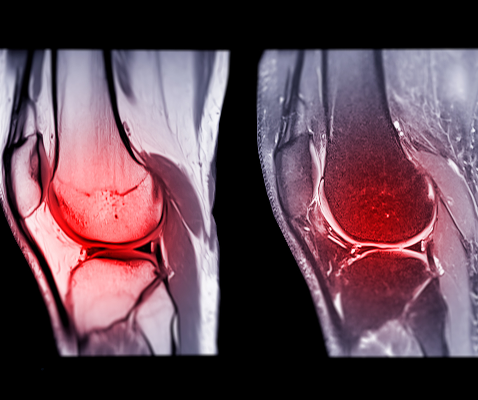 The Benefits of ACL Prevention Programs