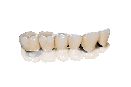Porcelain Fused to Metal Crowns | Vitality Technologies Dental Lab