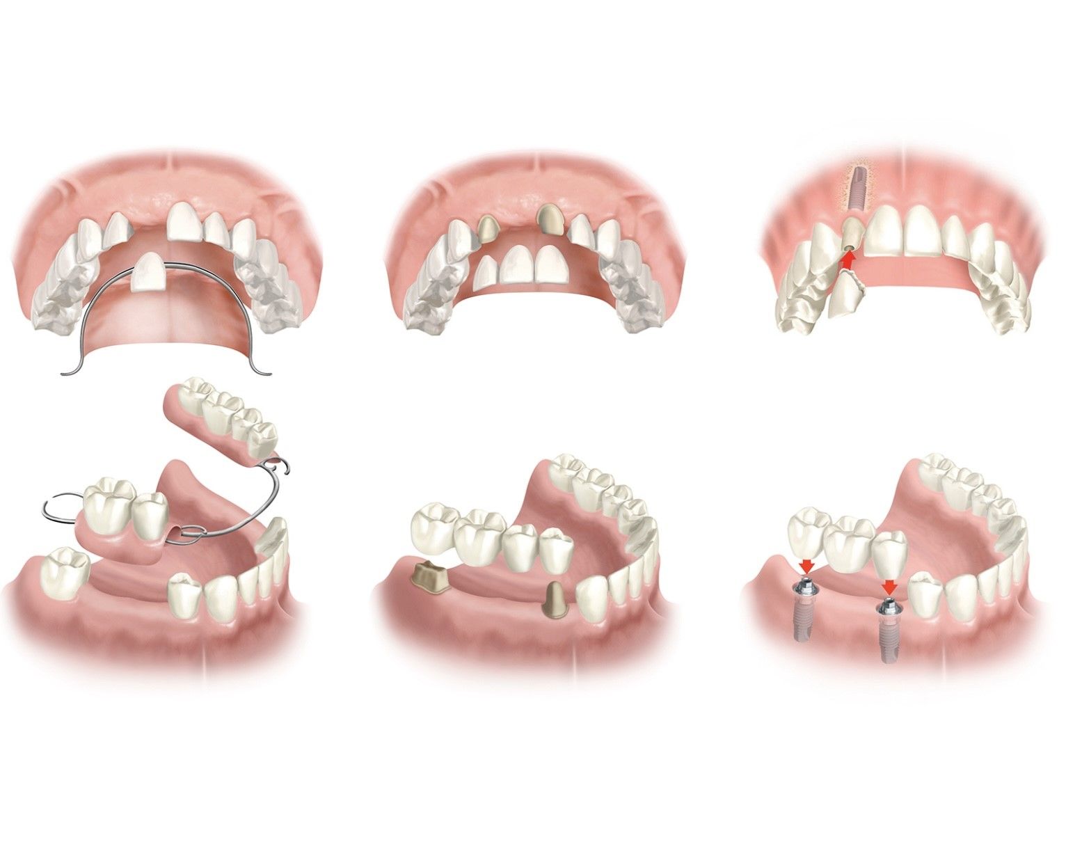 Dental Implants | Newton Dental | newton-le-willows