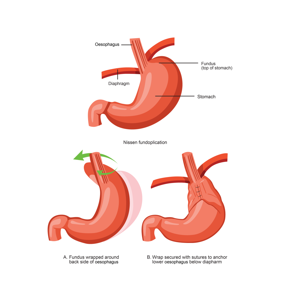 Anti Reflux Surgery | Hunter Weight Loss & Upper GI Surgeons