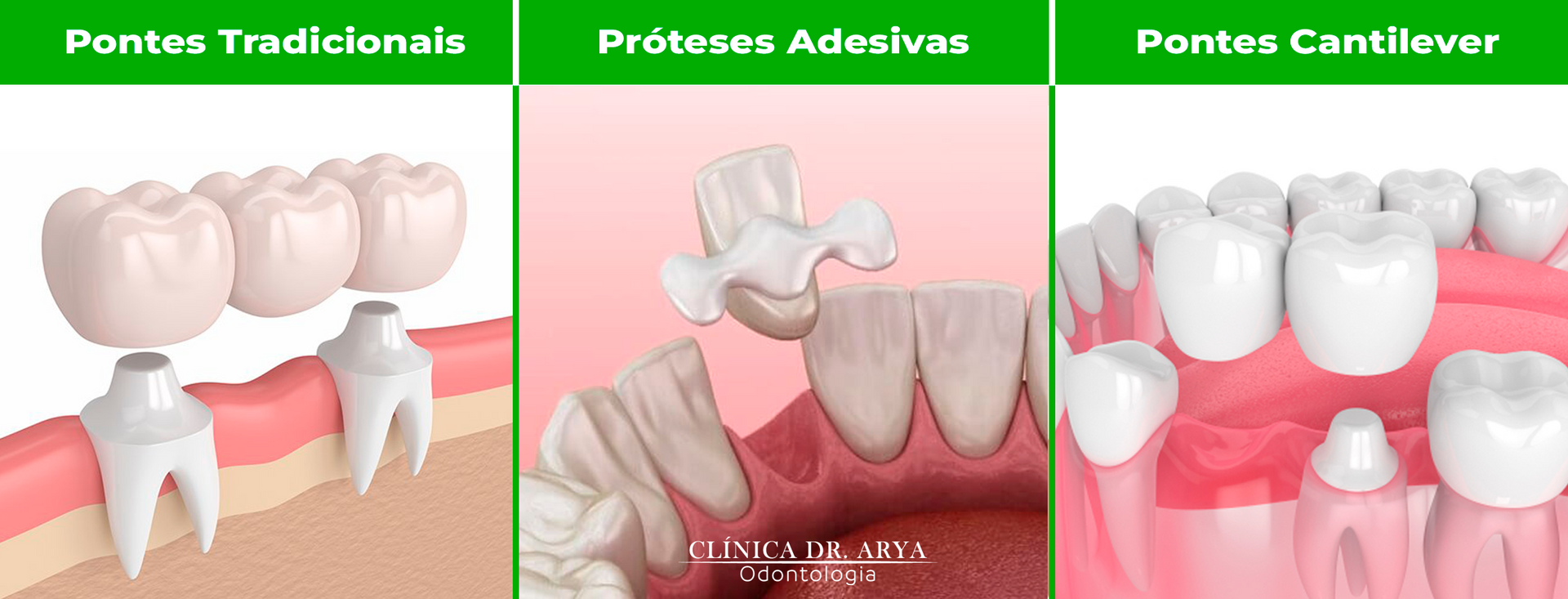As vantagens de escolher uma Ponte Fixa em vez de Implantes Dentários