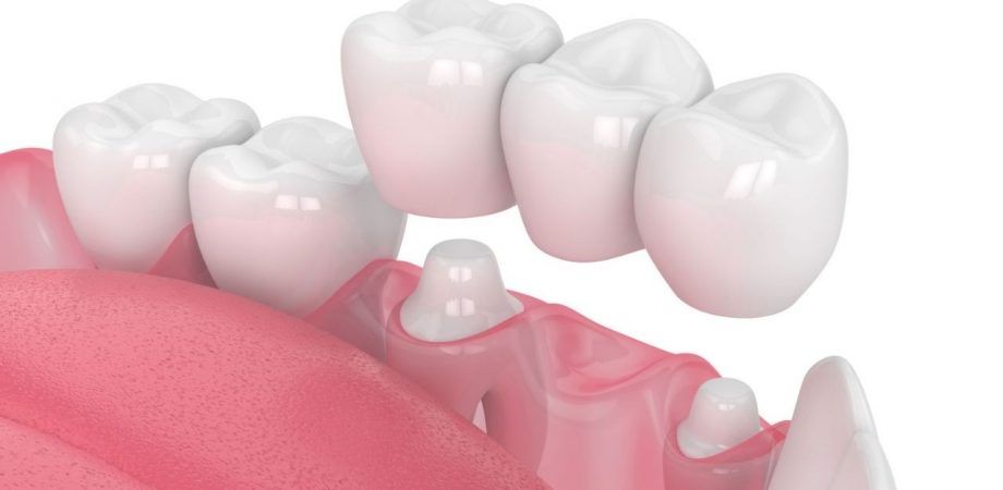 As vantagens de escolher uma Ponte Fixa em vez de Implantes Dentários