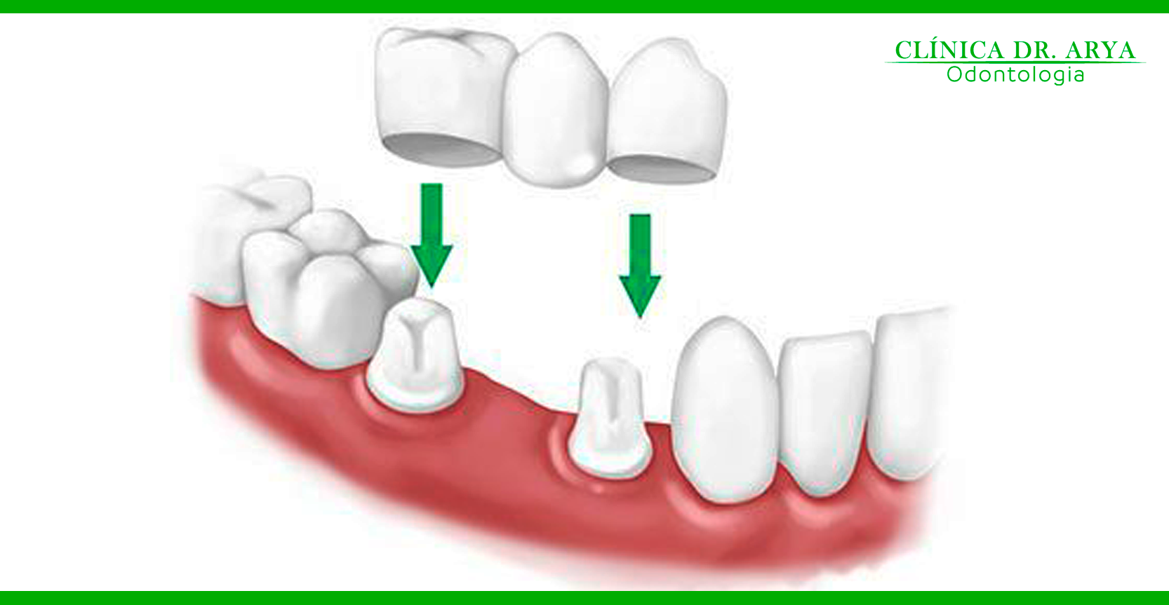 As vantagens de escolher uma Ponte Fixa em vez de Implantes Dentários