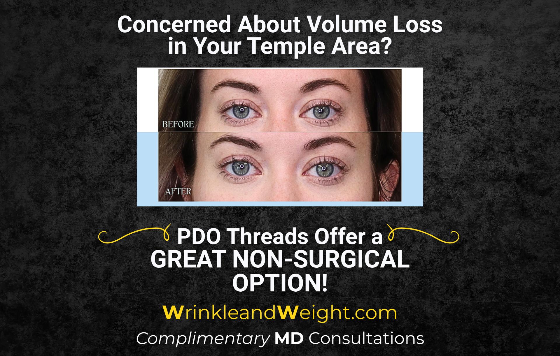 PDO Threads for Temple Volume Loss Westerville MedSpa