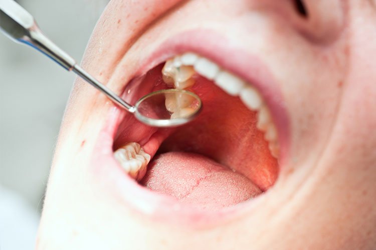 Orthodontic Removable Rapid Palate Expander - Jaw Expansion Near Me