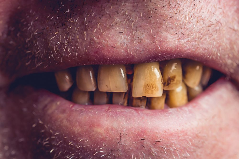 The Impact of Smoking on Your Teeth: What You Need to Know