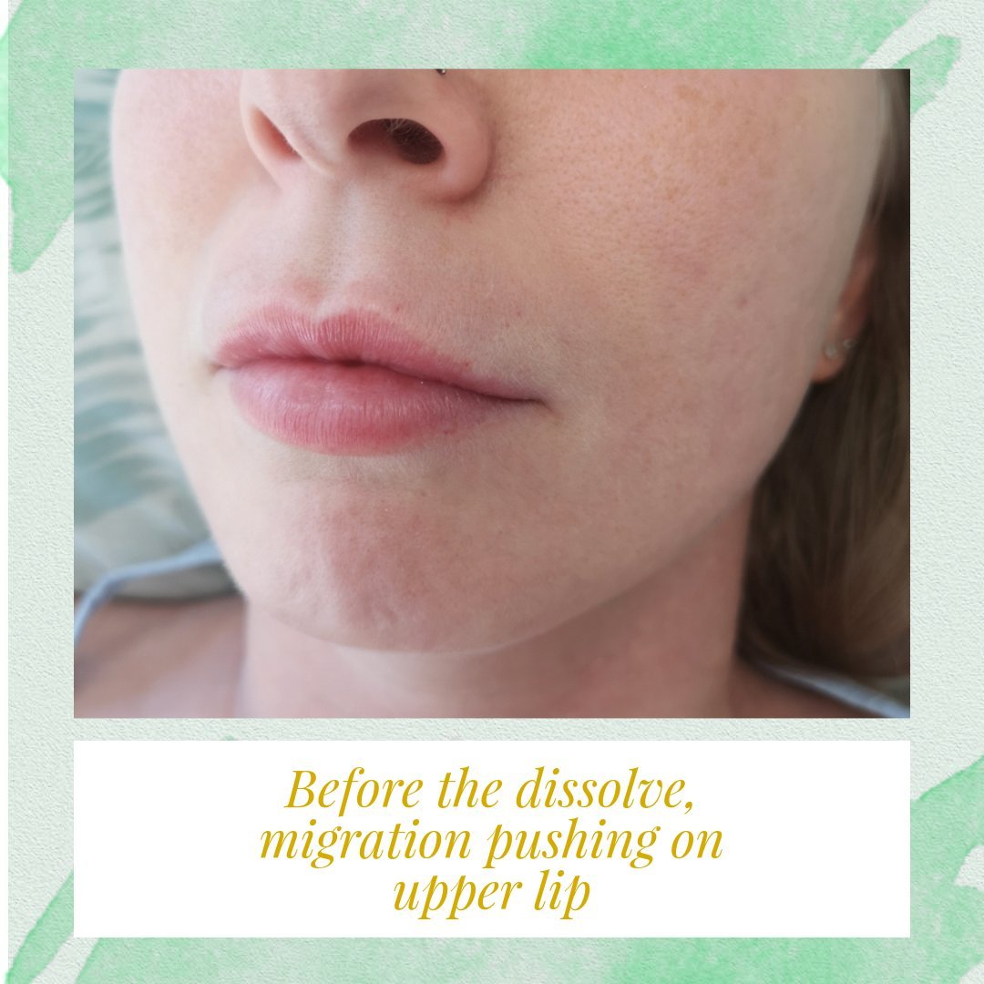Dissolving Lip Filler - Call of Beauty Aesthetics