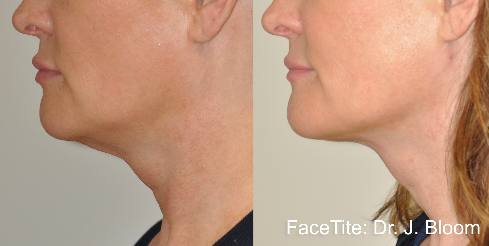 Facetite and Facial Surgeries | Robey Plastic Surgery