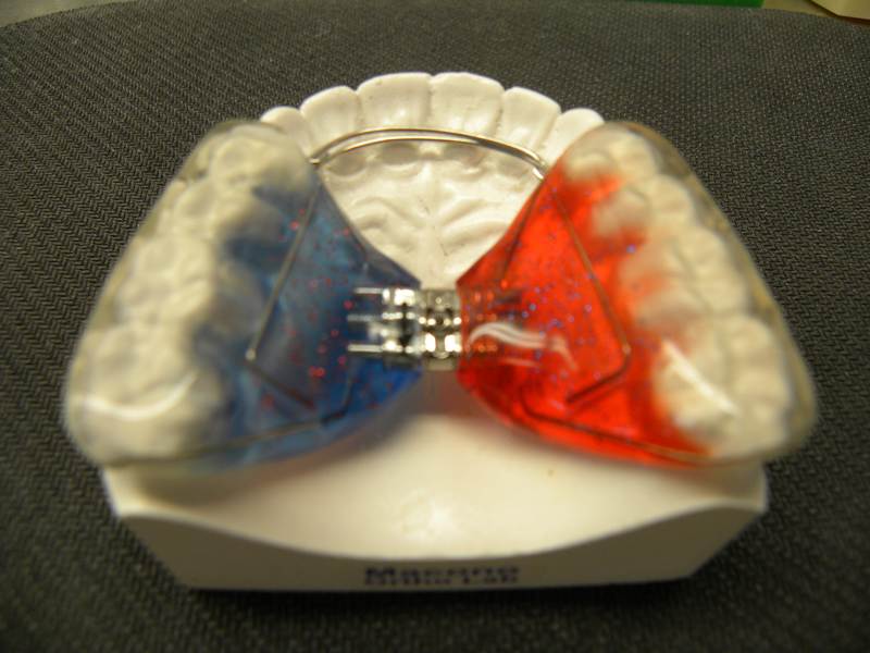 Orthodontic Appliances | Sydney, NSW | Macono Orthodontic & Dental ...