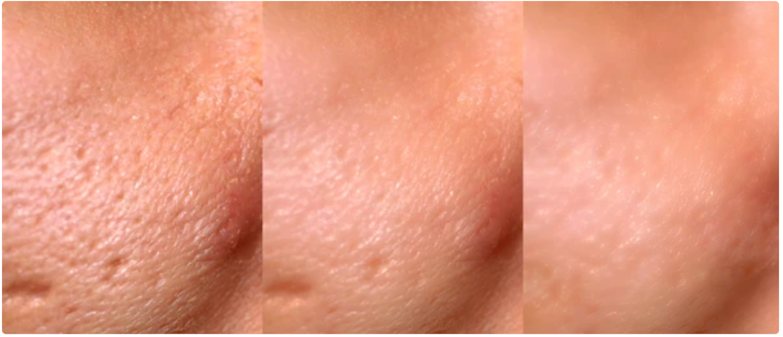 Medical Grade LASER Skin Resurfacing for Large Pores and Scars