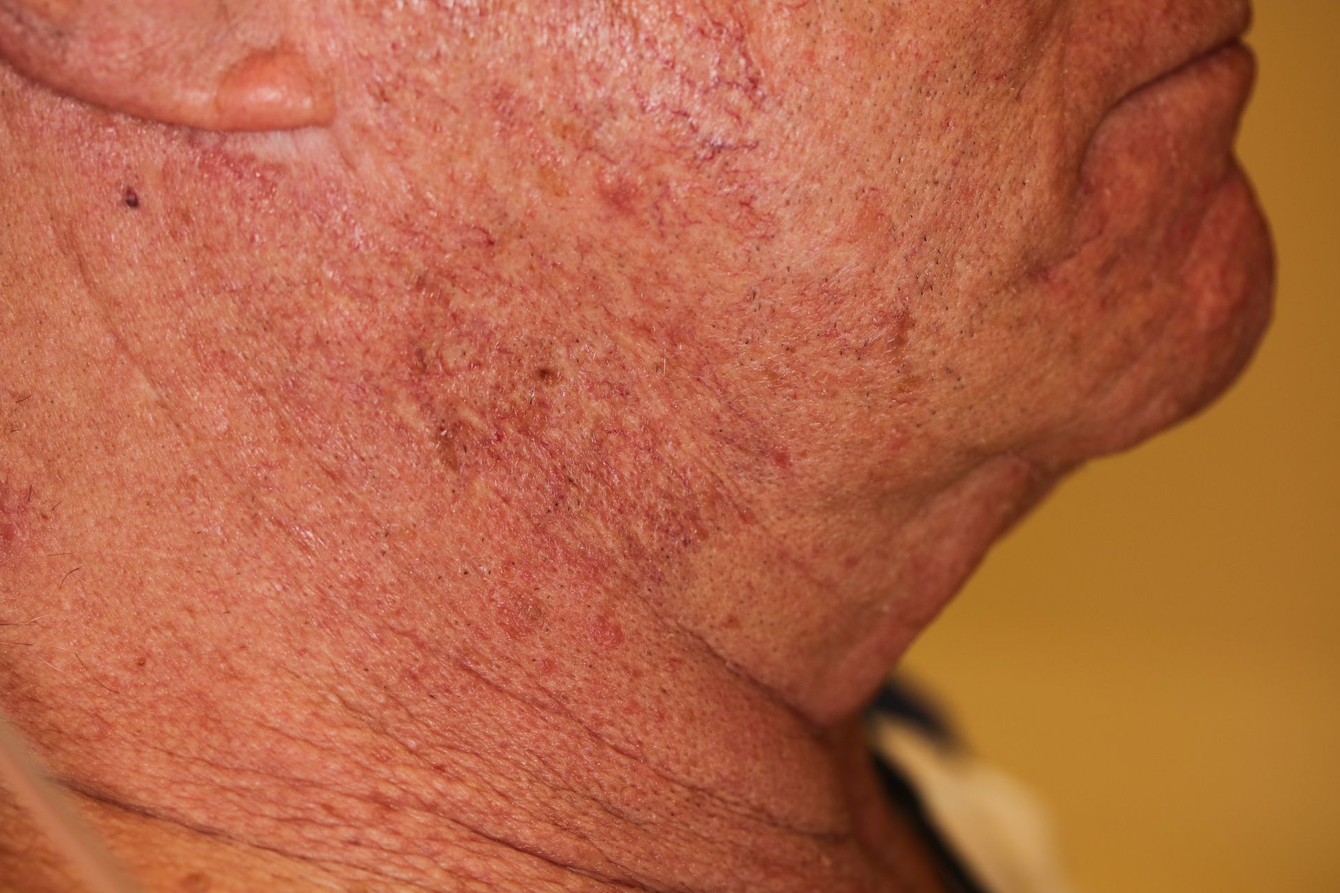 Gallery | Direct Neck Lift