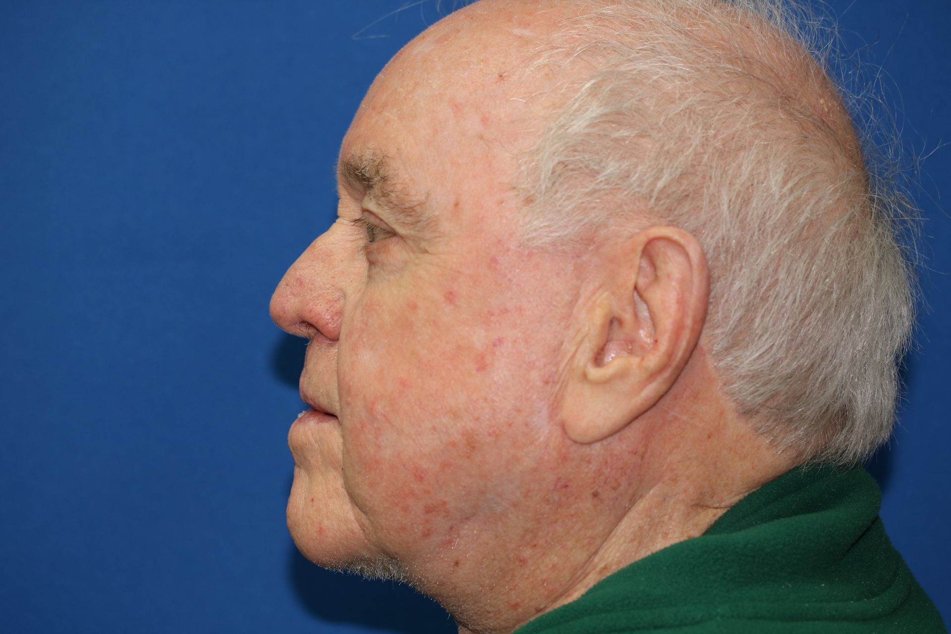 Gallery | Direct Neck Lift