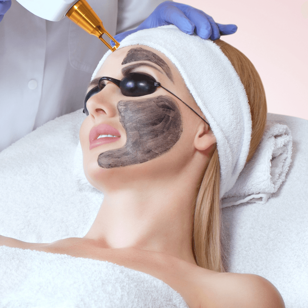 Carbon Laser Peeling