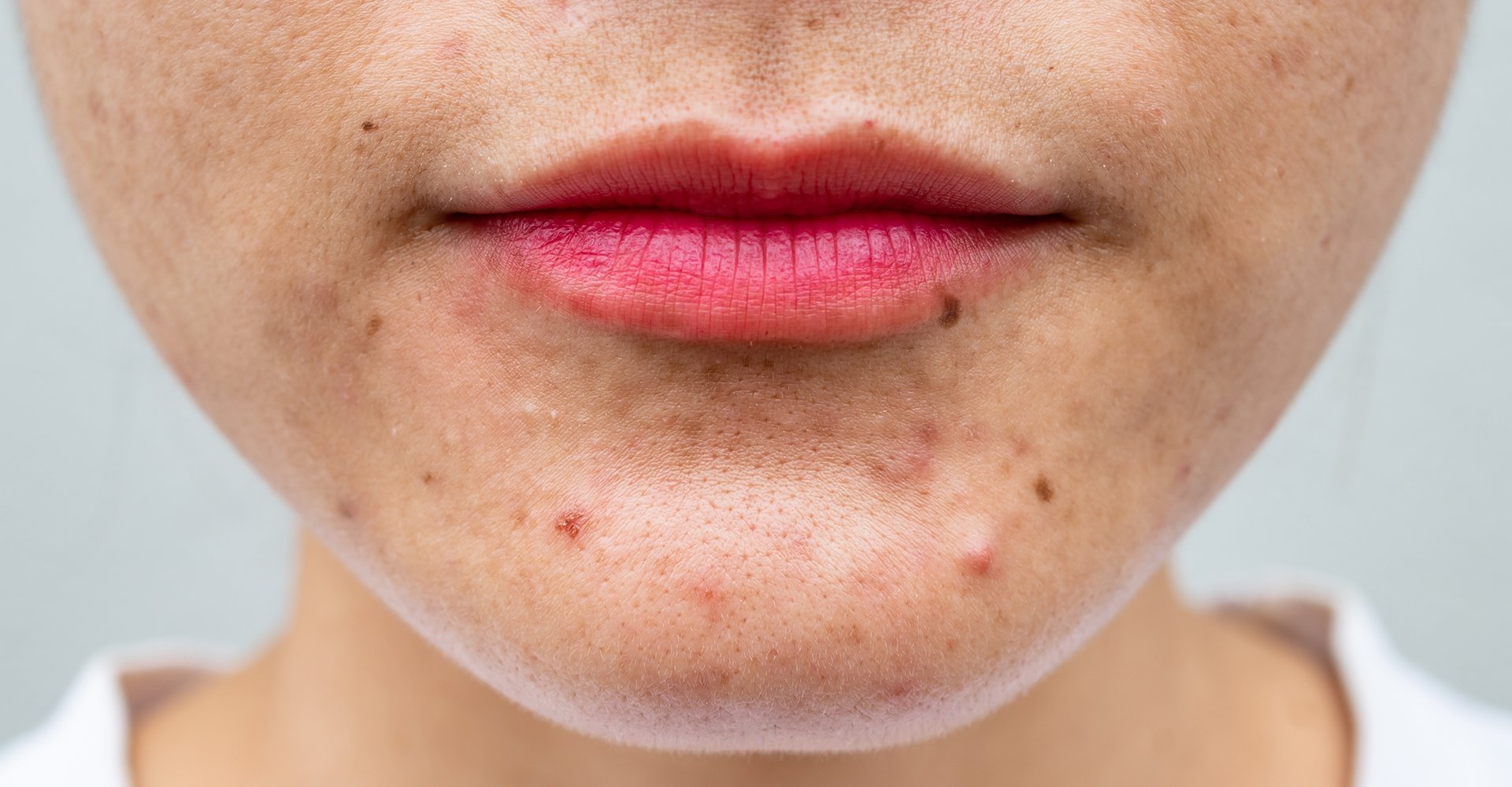 Dermatologist | Davenport, IA | William Colantoni Jr MD PC