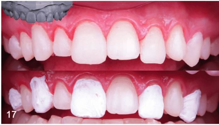 Digital Design | Cosmetic Dental Design | Australia