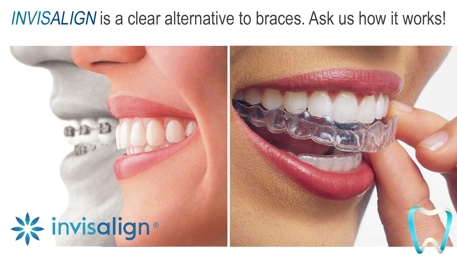 Invisalign | Lougheed Family Dental | Coquitlam Dentist