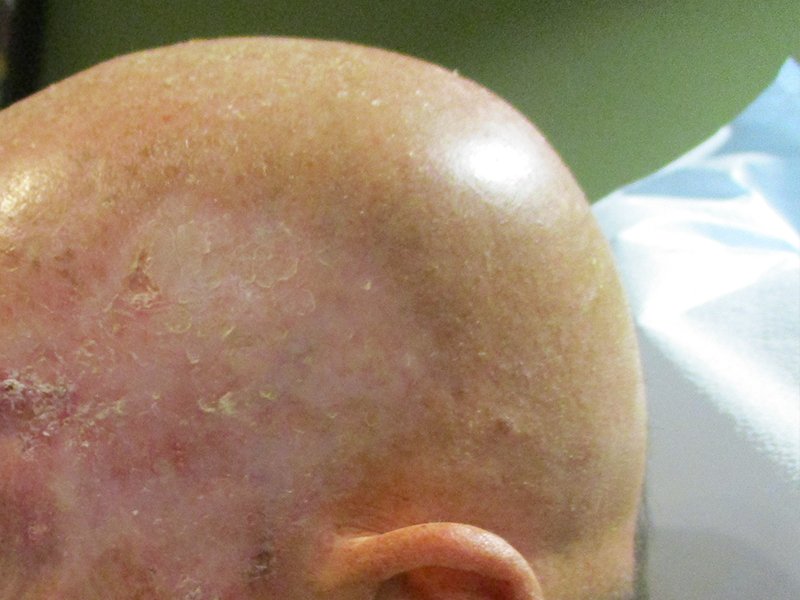 Skin Cancers | Southwest Oncology Centers