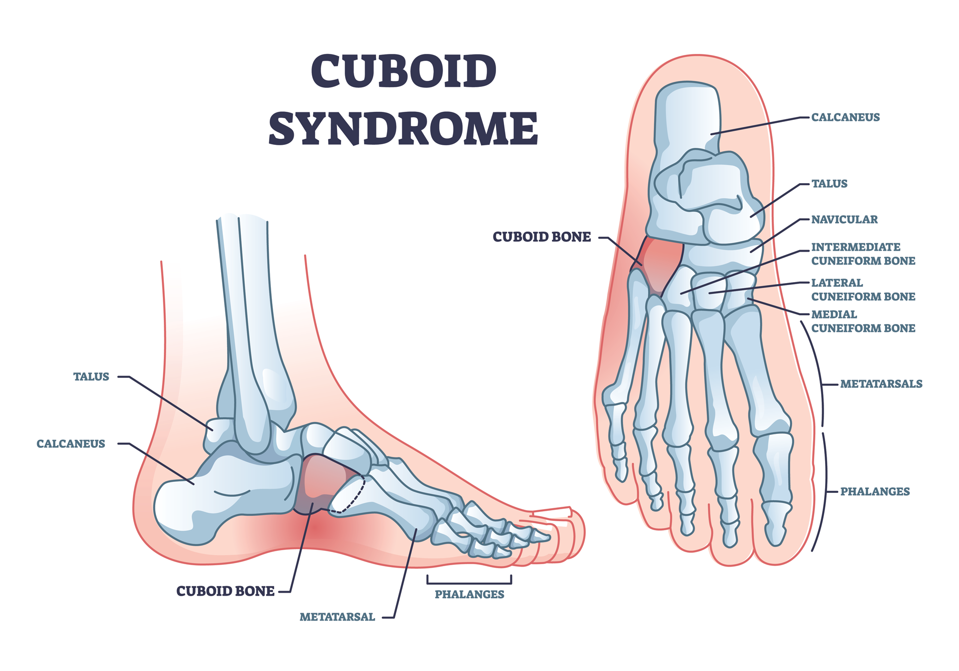 How to Treat Cuboid Syndrome with Physical Therapy
