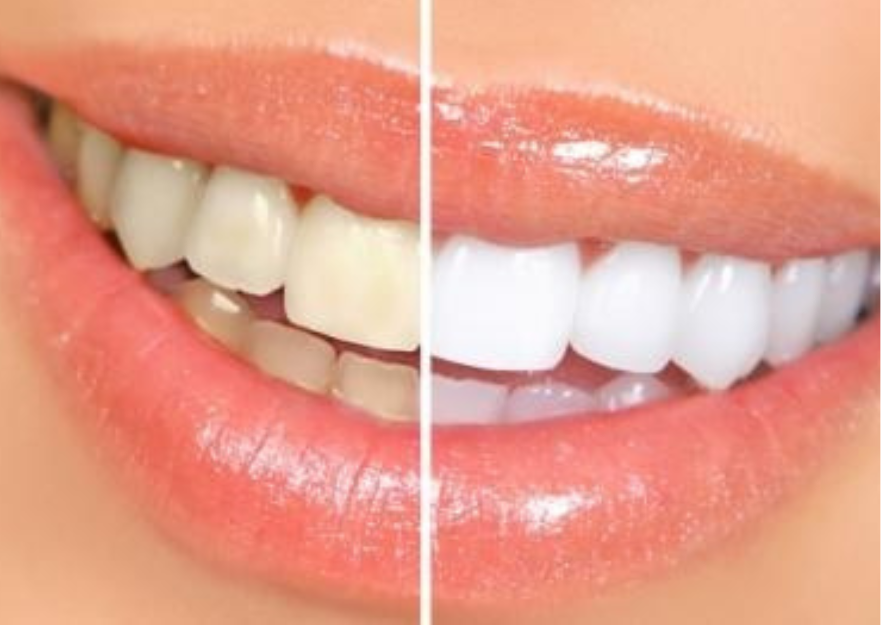 How Do Dental Veneers Work? A Complete Guide to Improving Your Teeth