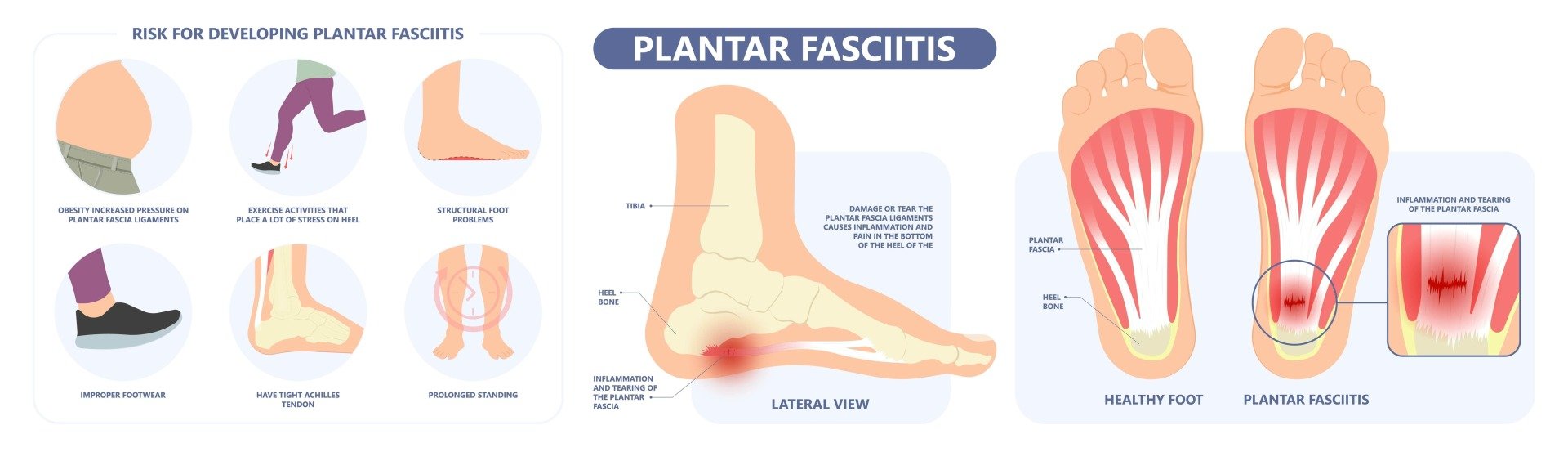 Dr David Samra | Plantar Fasciitis