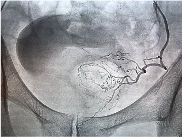 Prostate Artery Embolisation | Melbourne Vic Australia