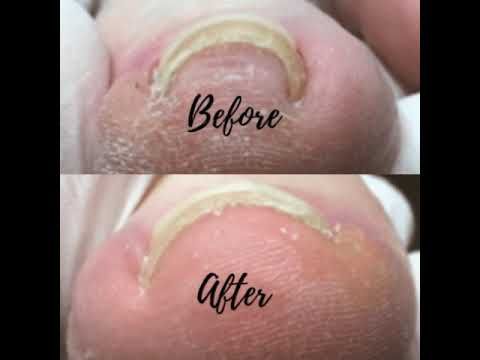 Professional Nail Correction | Ingrown Toenail Treatment | Sappington ...