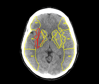 Cardiovascular Imaging Software | Circle Cardiovascular Imaging (Circle ...