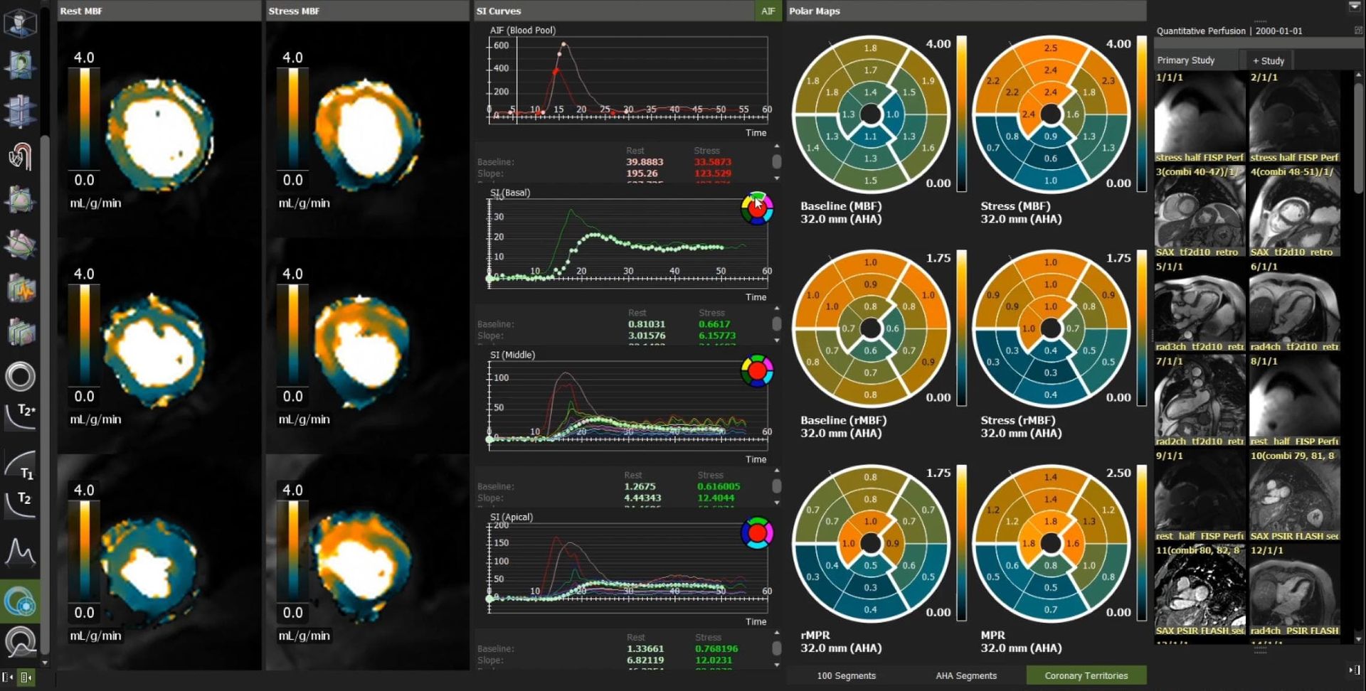 Cardiac MR Software | Circle Cardiovascular Imaging (Circle CVI) | Global