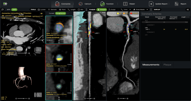 Coronary Plaque Quantification | Circle Cardiovascular Imaging (Circle CVI)