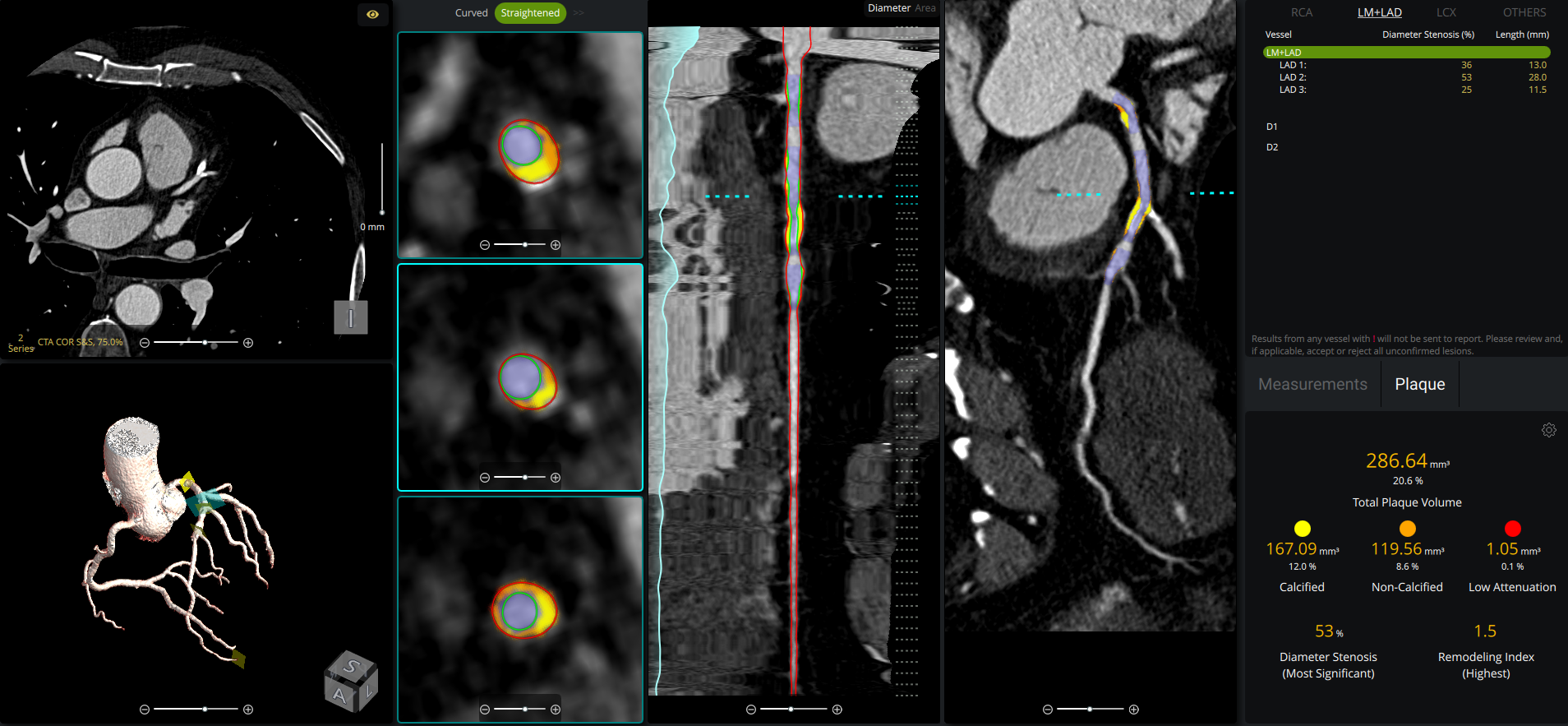 Coronary Plaque Quantification | Circle Cardiovascular Imaging (Circle CVI)