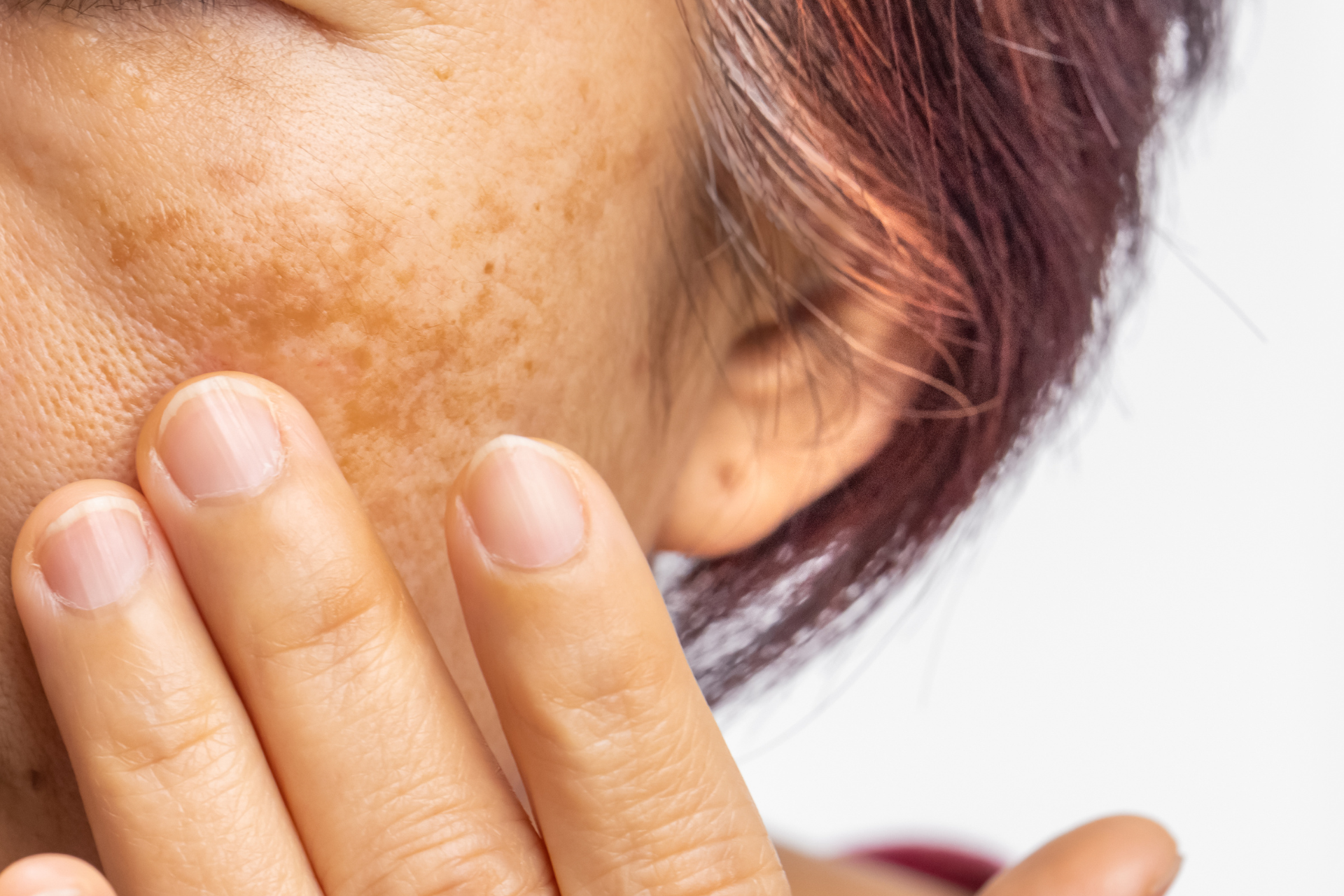 Everything You Need to Know About Age Spots and How to Treat Them