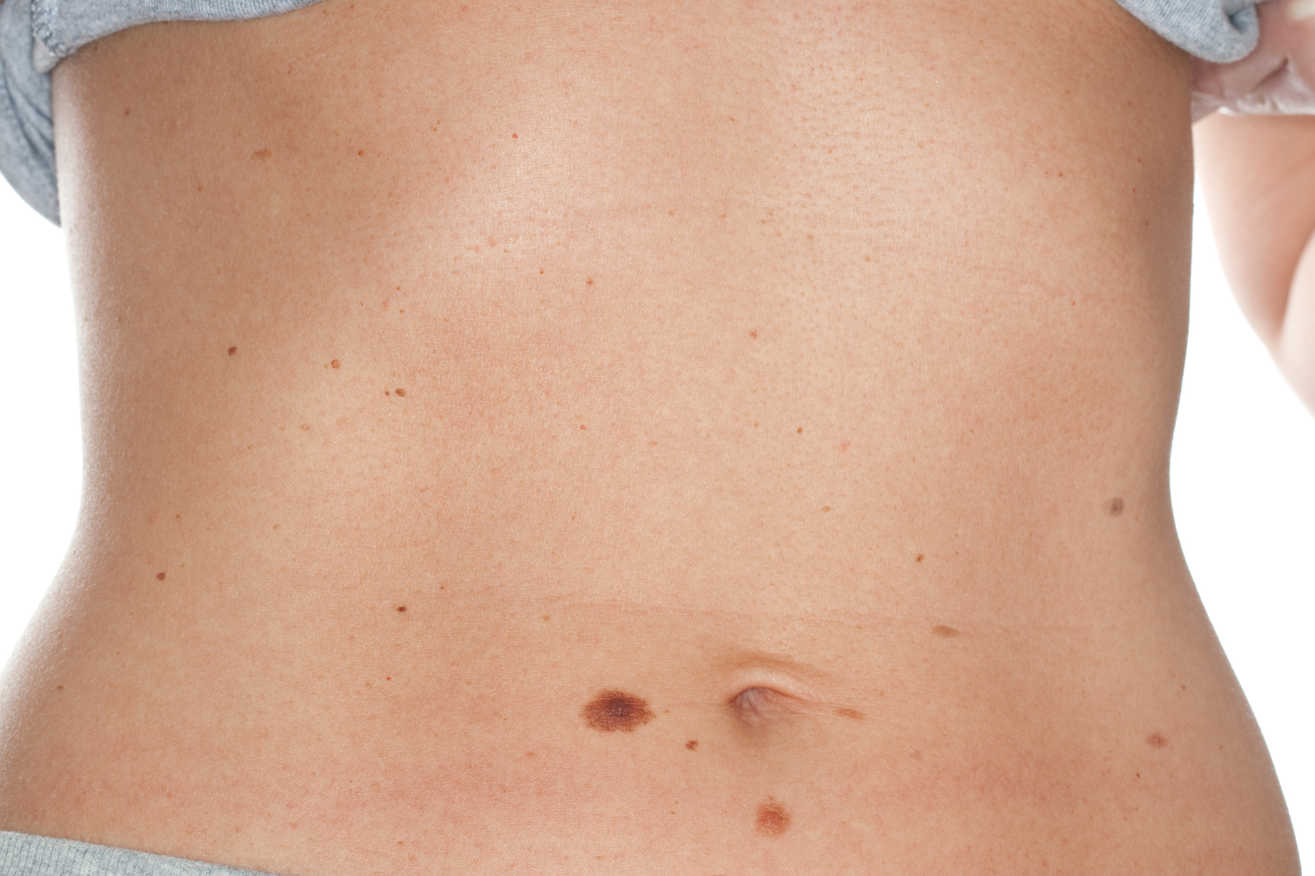 Top 5 Areas Where Skin Cancer Is Most Common: A Guide to High-Risk Spots