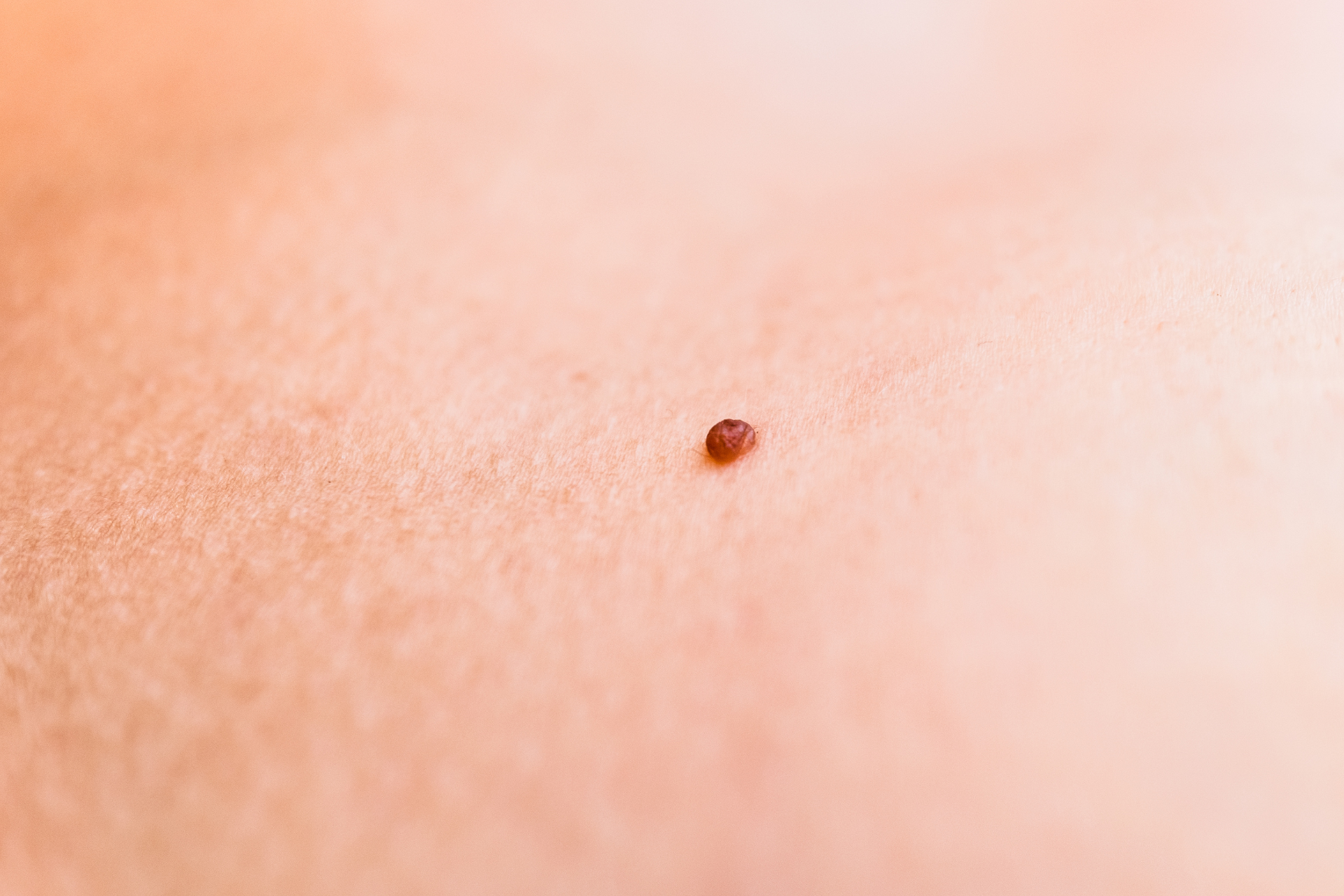 Can Warts Develop Without HPV? Exploring the Causes