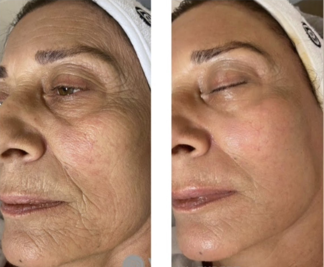 Advanced Facial treatments