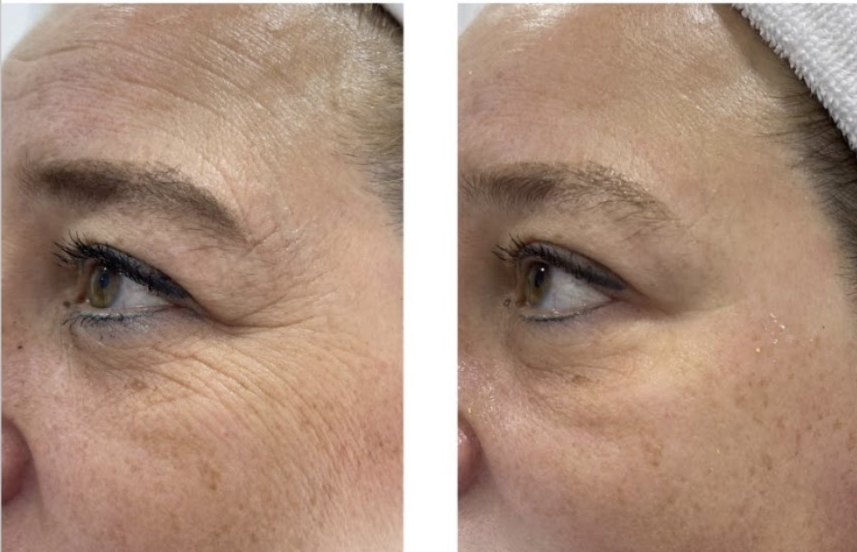 Advanced Facial treatments