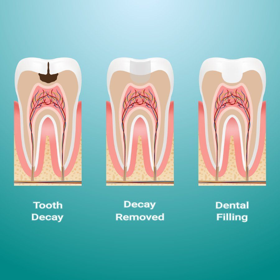 Tooth Fillings | Hampden Ave Dental | Lakewood, CO