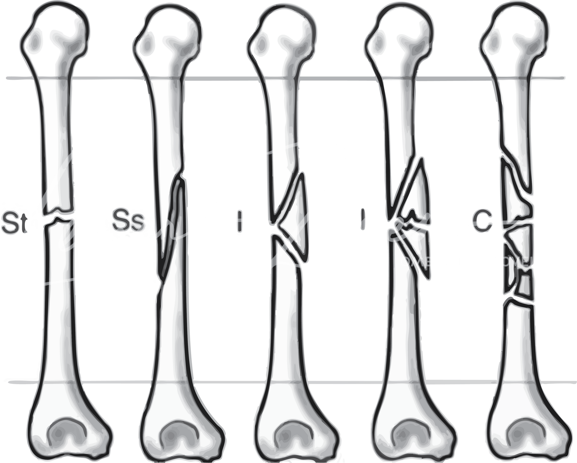Fraturas da Diáfise do Úmero - Saiba Como Avaliar e Tratar