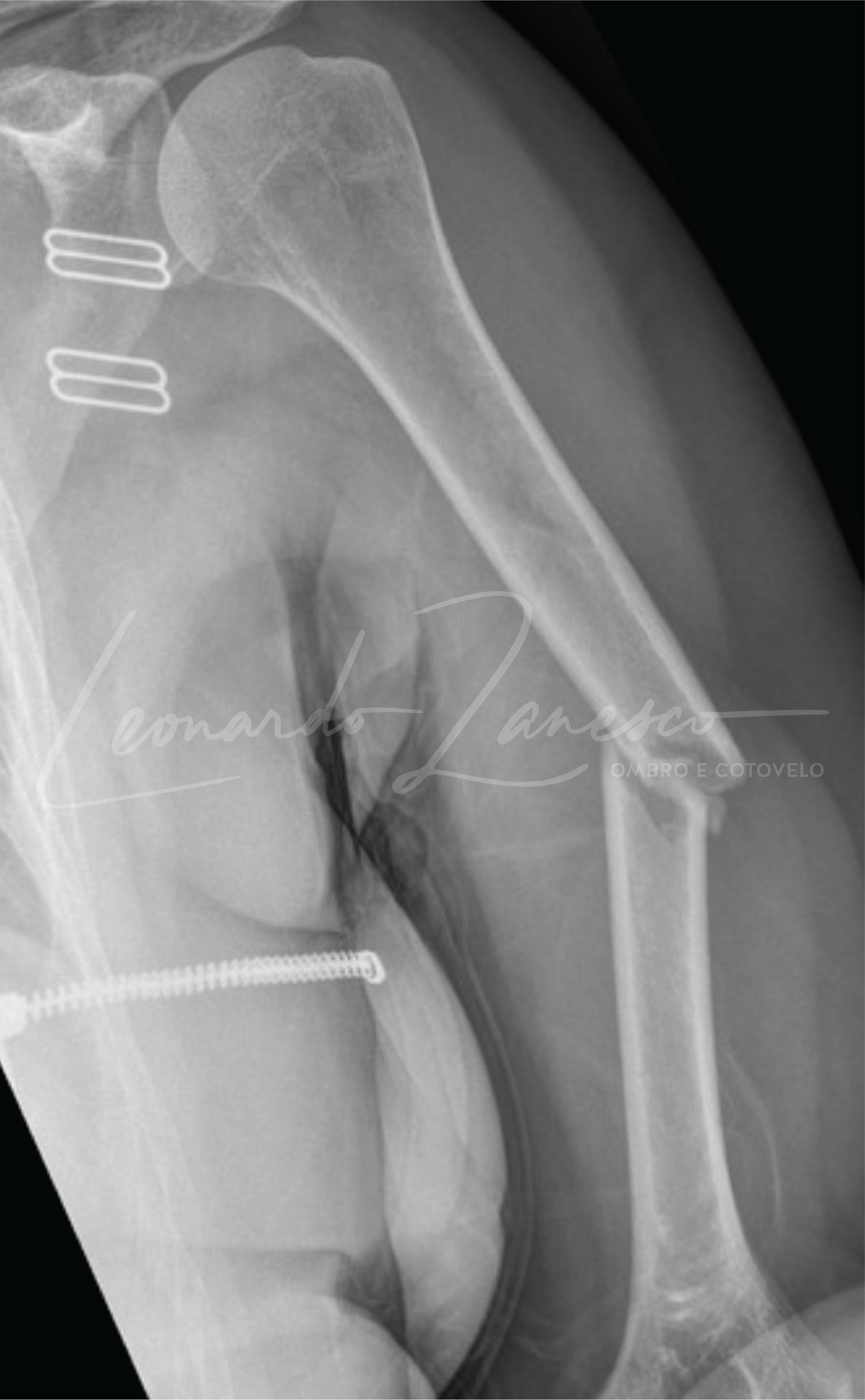 Fraturas da Diáfise do Úmero - Saiba Como Avaliar e Tratar
