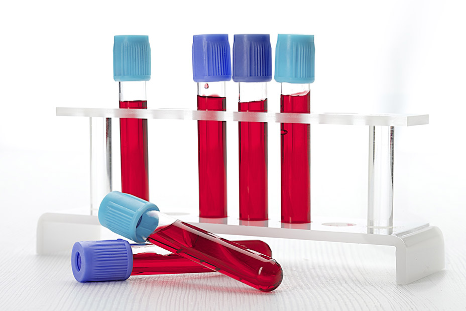 ¿Sabes qué es una Unidad de Aféresis?