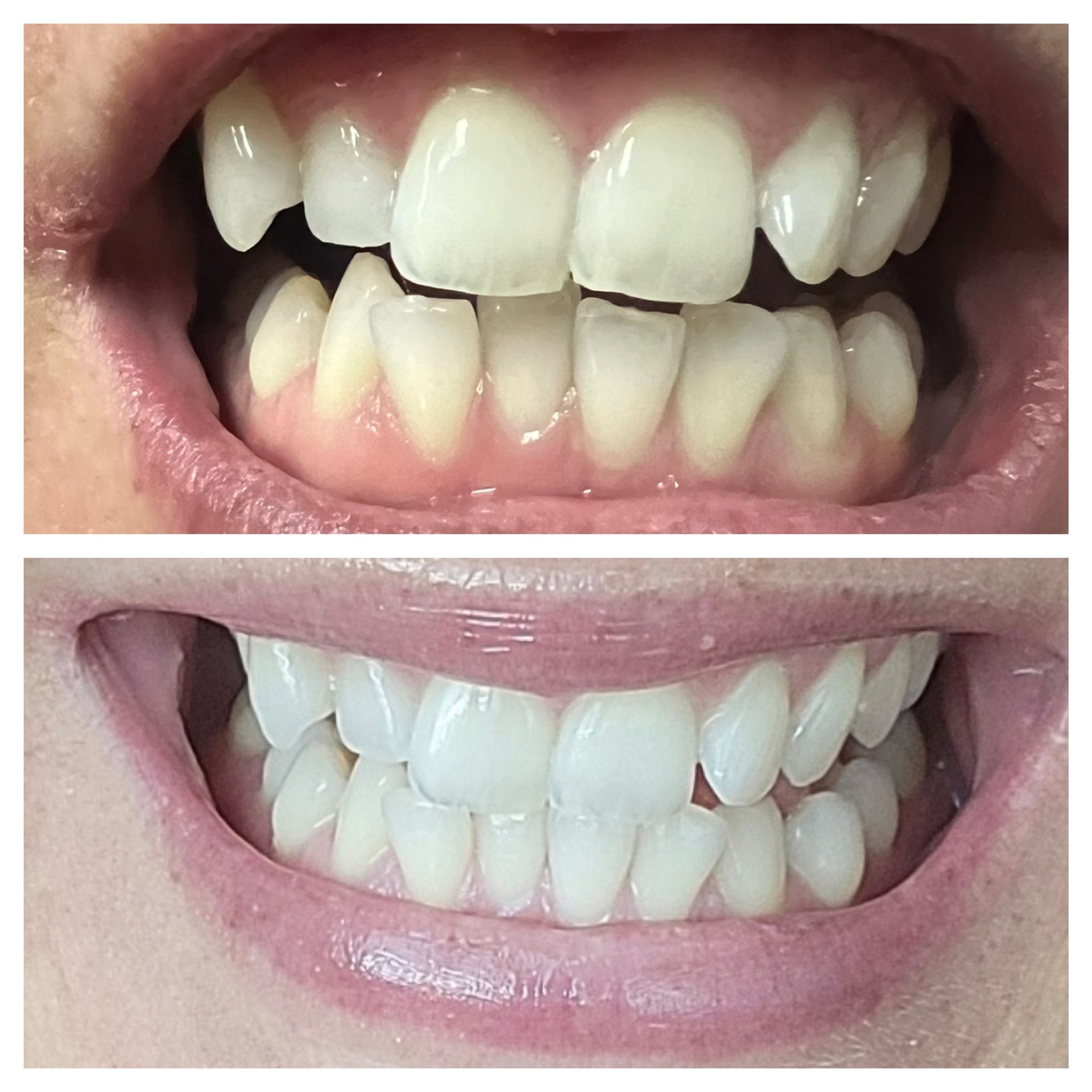 Teeth Whitening Results | Brite Smiles by Heather