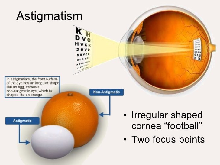 Lasik | Helm Vision Group