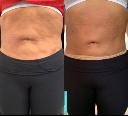Non-invasive Procedure – Minneapolis, MN - InstaSculpting Body Contour ...