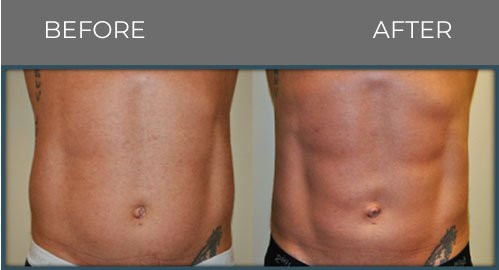 Non-invasive Procedure – Minneapolis, MN - InstaSculpting Body Contour ...