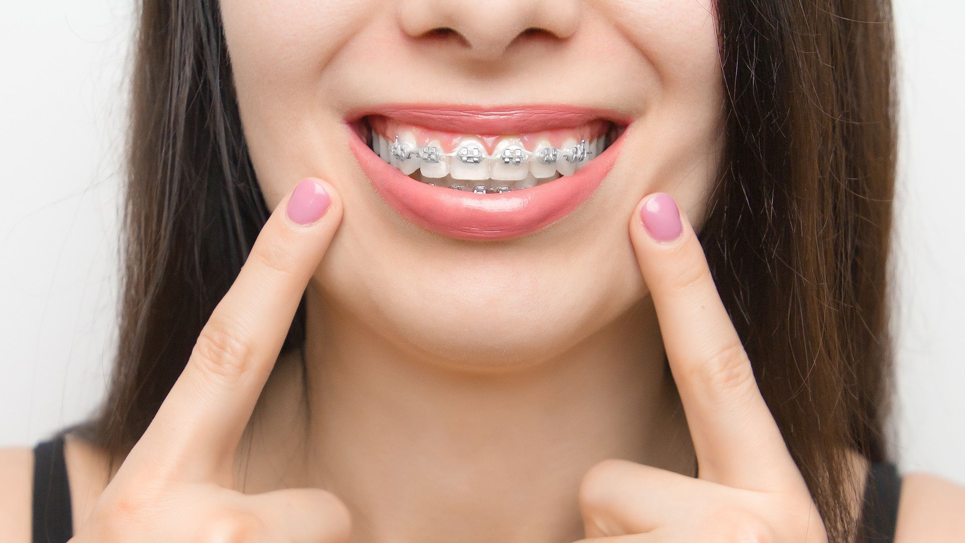 What Are Self-Ligating Braces? A Complete Guide