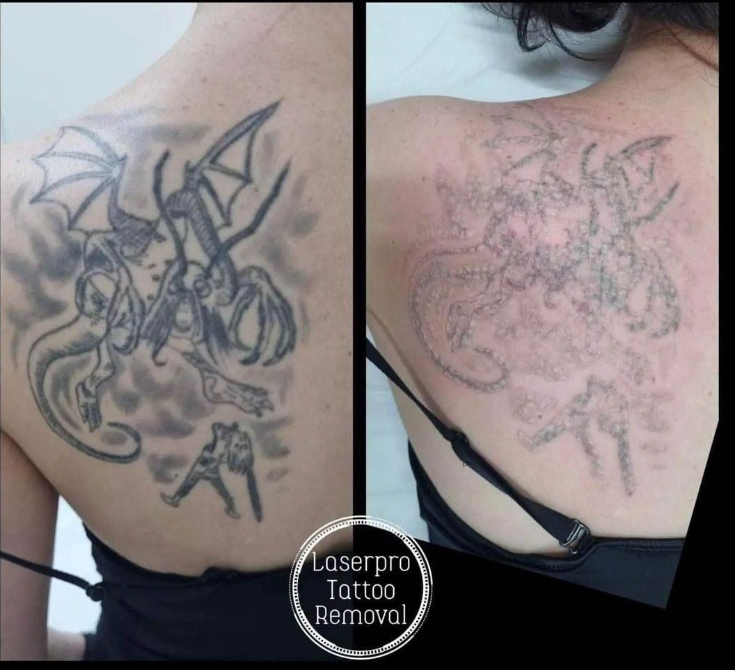 Contact Us | Laserpro Tattoo Removal