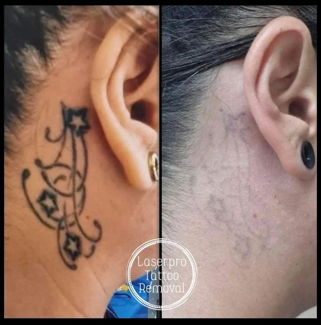 Cosmetic Tattoo Removal in Shellharbour | Laserpro Tattoo Removal
